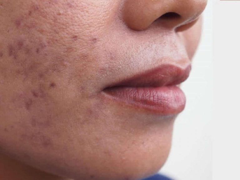Laser and Light-Based Therapies For Post-Acne Hyperpigmentation - Thẩm ...